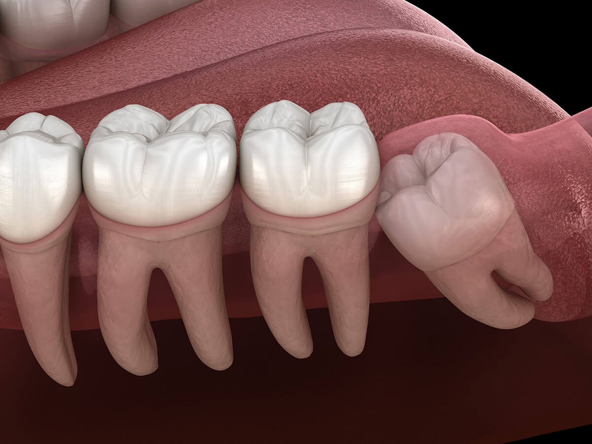 Wisdom Teeth Removal - Excel Dentistry and Braces - Oklahoma City, OK